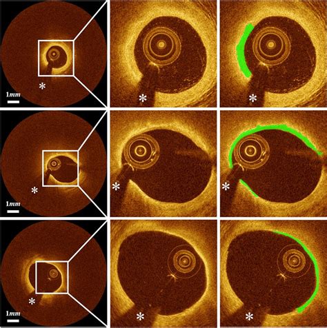 Automated Thin Cap Fibroatheroma Detection Results On The Held Out Test Download Scientific