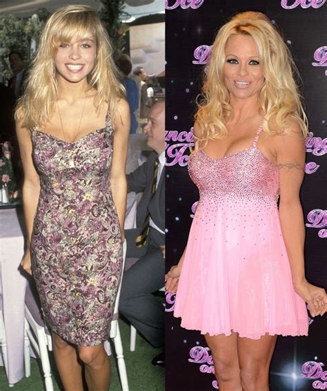 Pamela Anderson And Plastic Surgery