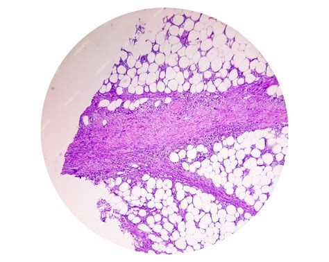 Premium Photo Photomicrograph Of Granulomatous Tissue Histology Showing Foreign Body Granuloma