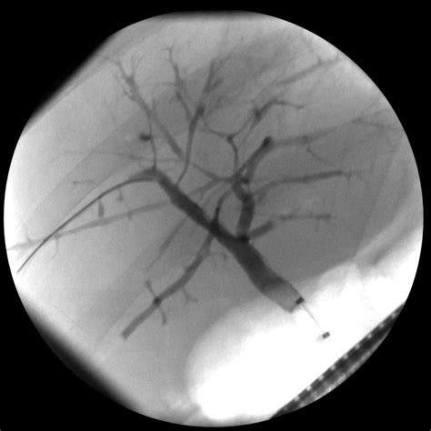 File Igg4 Related Autoimmune Cholangitis Pancreatitis And Pseudotumor Radiopaedia 99511