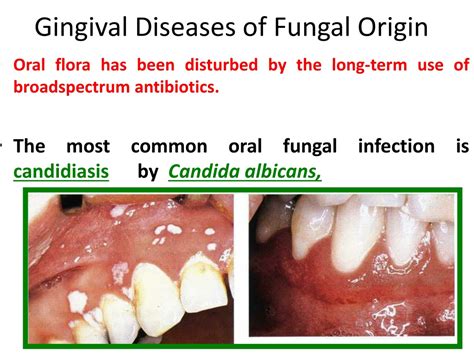 Ppt Classification Of Periodontal Disease Powerpoint Presentation