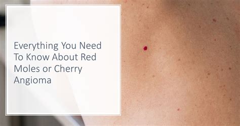 Cherry Colored Moles