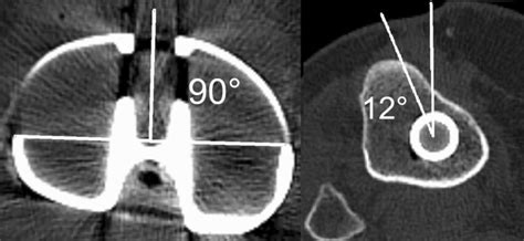 Tibial Component Rotation Measurement In This Case 12° Of Internal Download Scientific