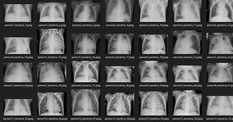 Pneumonia Detection Using CNN
