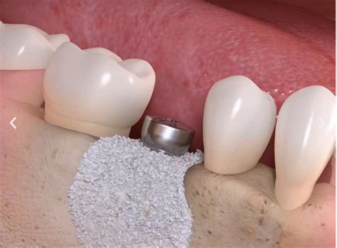 What Is Bone Graft Dental Bone Grafting Techniques And Materials For