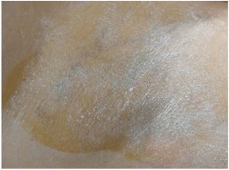 Hyperhidrosis Plastic Surgery Key