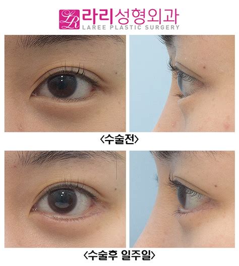 [라리성형외과] 속눈썹찔림 안검내반교정수술이 필요할 때 네이버 블로그
