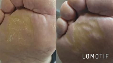 Натоптыши на ногах лечение натоптышей на ступнях удалить натоптыши на ногах в Днепре Подо