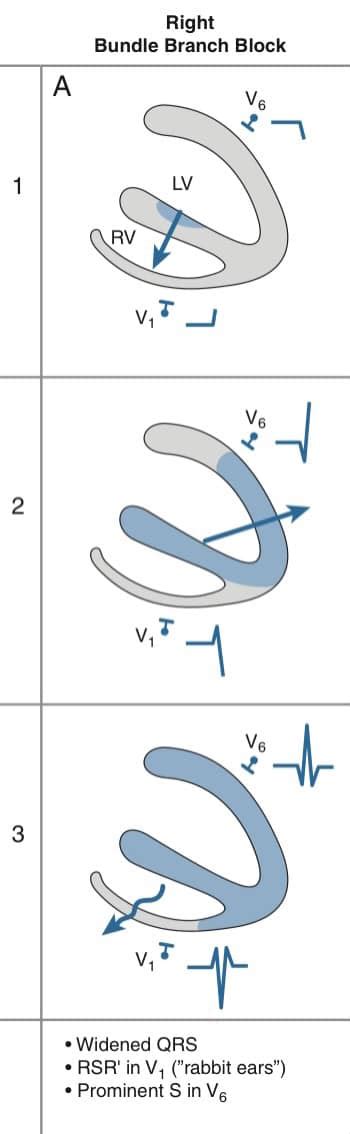 Secret Medicine [typical Rbbb ใน Ekg เราจะพบ Right Axis