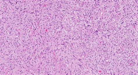 Malignant Peripheral Nerve Sheath Tumour Atlas Of Pathology