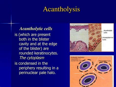 Acantholytic Cells