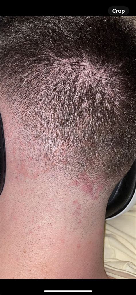 Is This Ringworm Psoriasis Irritation Rdermatologyquestions