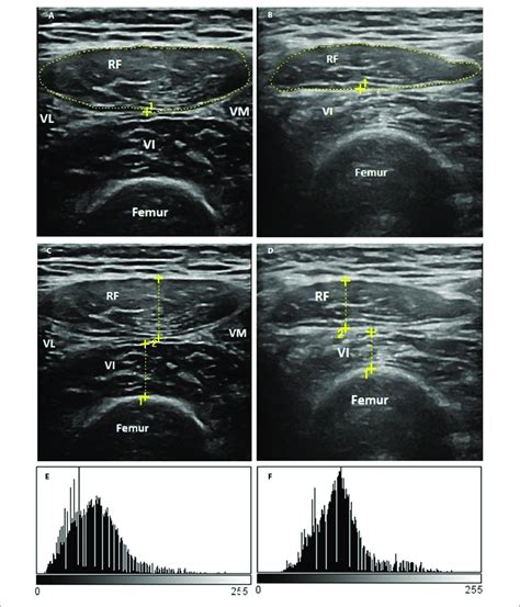 Representative Qualitative Muscle Ultrasound Image Rectus Femoris Download Scientific