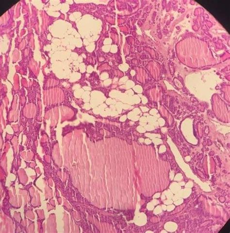 A B Histopathological Findings Of The Thyroid Gland Diffuse Download Scientific Diagram