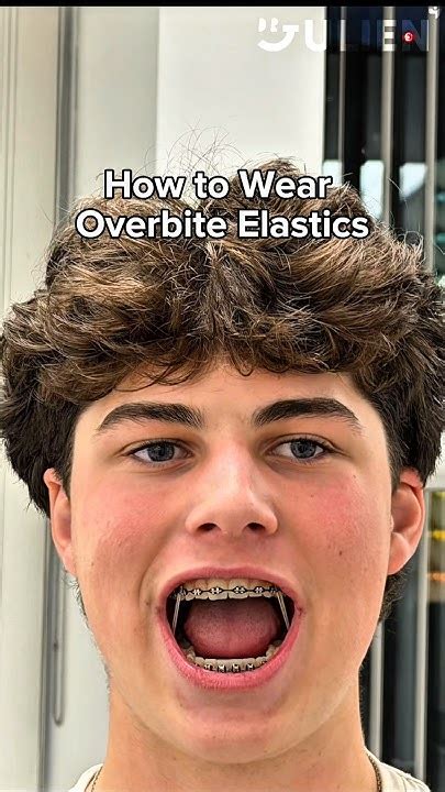 This Is How You Wear Class 2 Overbite Elastics Braces Youtube