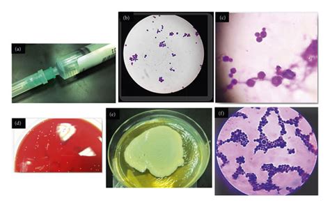 A Clear Colorless CSF Sample Other Etiological Causes Of Meningitis Download Scientific