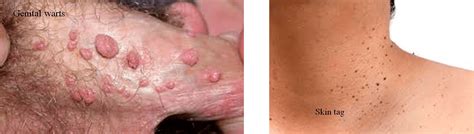Is This Genital Warts Skin Tags Or Molluscum Contagiosum Comprehensive