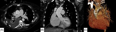 Preoperative Cta Demonstrating Diffuse Circumferential Calcification Download Scientific