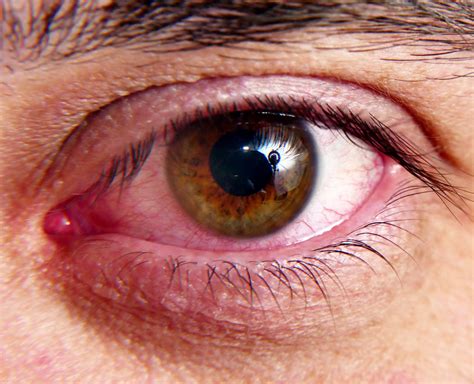 Dry Eye Syndrome Understanding Symptoms And Causes Westwood Opticians