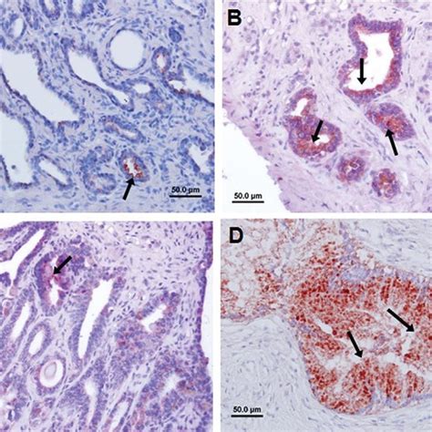 Association Of Atad3a Expression With Secretory Function Benign