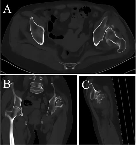 Frontiers Diagnostic Value Of Multiple Projection Angle X Ray And Ct