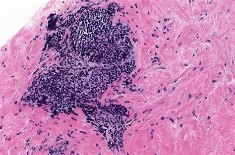 Pathology Outlines Lymphocytic Diabetic Mastitis