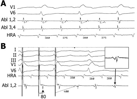 Tracings Show Examples Of Fractionated Electrograms And Bystander And Download Scientific