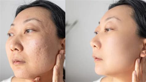 Follicular Macular Atrophy