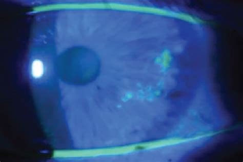 My Patient Has Herpetic Keratitis Now What