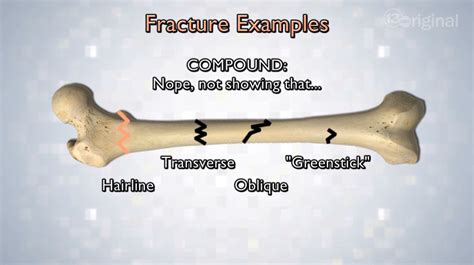 Compound Bone Fracture