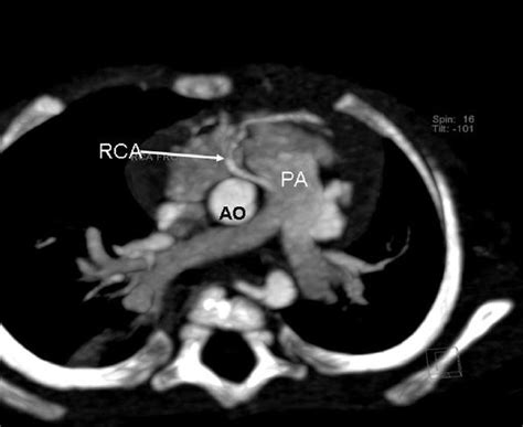 Anomalous Origin Of Right Coronary Artery From Pulmonary Artery