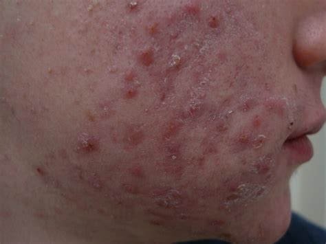 Acne Treatments Brisbane Skin Dermatologist