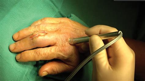 Dorsal Metacarpal Artery Flap And Dorsal Metacarpal Artery Perforator Flap Clinical Tree