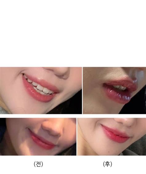 얼태기 극복 강남역피부과에서 입술필러입꼬리보톡스 하고 1000만족한 찐 후기 2주뒤 리터치까지💕 멍통증주의사항 네이버 블로그