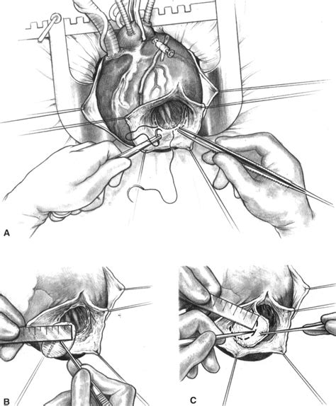 Surgical Management Of Left Ventricular Aneurysms By The