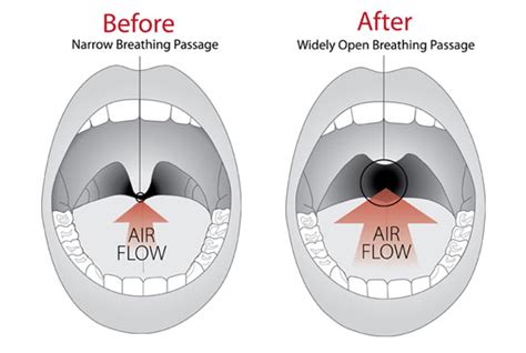 Uvulopalatopharyngoscopy Uppp Procedure And Medical Tourism Options