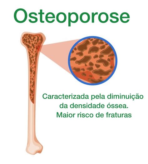 Tíbia O Principal Osso Da Perna Dr Thiago Protta