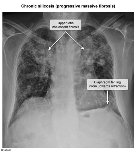 Silicosis Pulmonary And Critical Care Uworld Medical Library