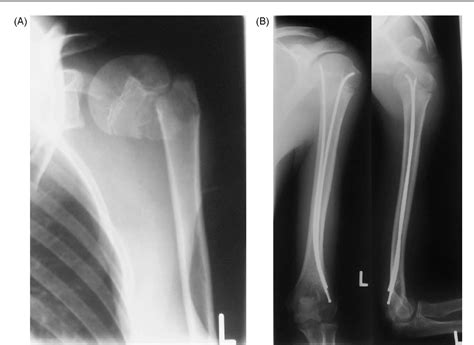 Epiphyseal Fracture Semantic Scholar