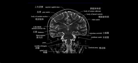 影像解剖：头颅mr冠状面解剖中英文对照 Medsci Cn
