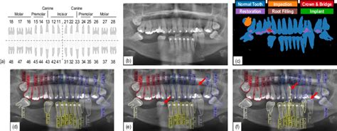 Illustrations Of Teeth Localization Results A The Fdi Tooth Download Scientific Diagram