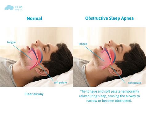 Sleep Apnea Symptoms Causes Diagnosis And Treatment