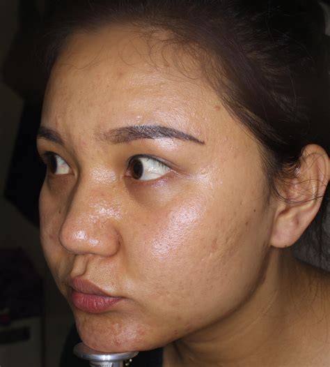Acne Object Detection Dataset V2 Non Label Acne By New Workspace Ii6dw