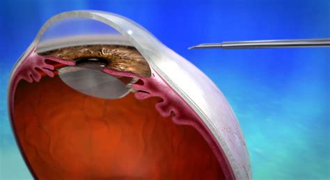 Tiny Tube Saving Sight Of Glaucoma Patients In New Zealand NZ Herald