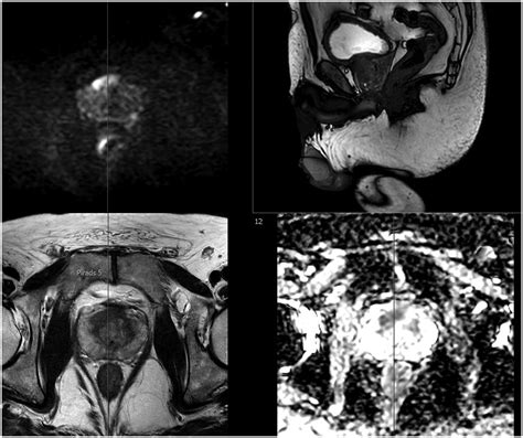 Comparison Of Bi And Multiparametric Magnetic Resonance Imaging To Select Men For Active