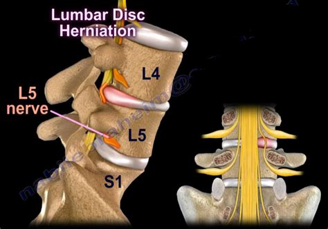 Piriformis Syndrome Tests Piriformis Syndrome Is Very A Popular… By Nabil Ebraheim Medium