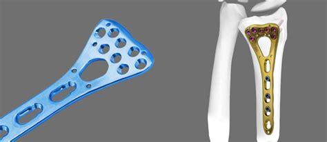 Variable Angle Locking Plates Types And Benefits Hemc Ortho
