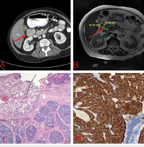 A Ct Abdomen And Pelvis With Contrast Displaying A Lobulated Soft Download Scientific Diagram