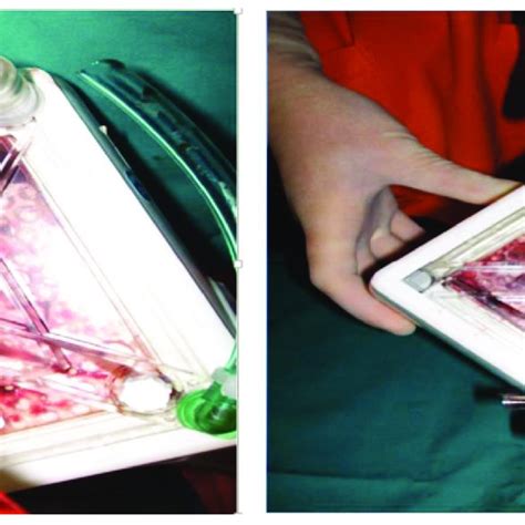 Clotting Of Oxygenator As Seen Enface With A Torch On The Maquet Download Scientific Diagram