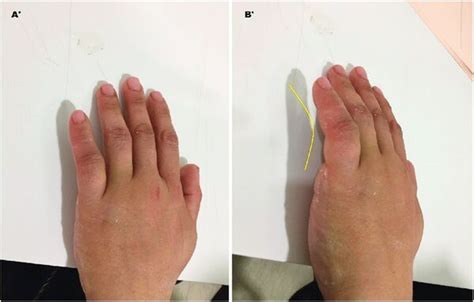 Metacarpophalangeal Joint Dislocation Wikism Sports Medicine Wiki